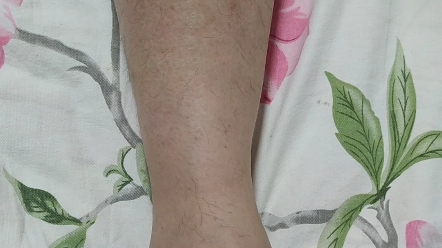 针灸透穴之商丘透丘虚,条口透承山