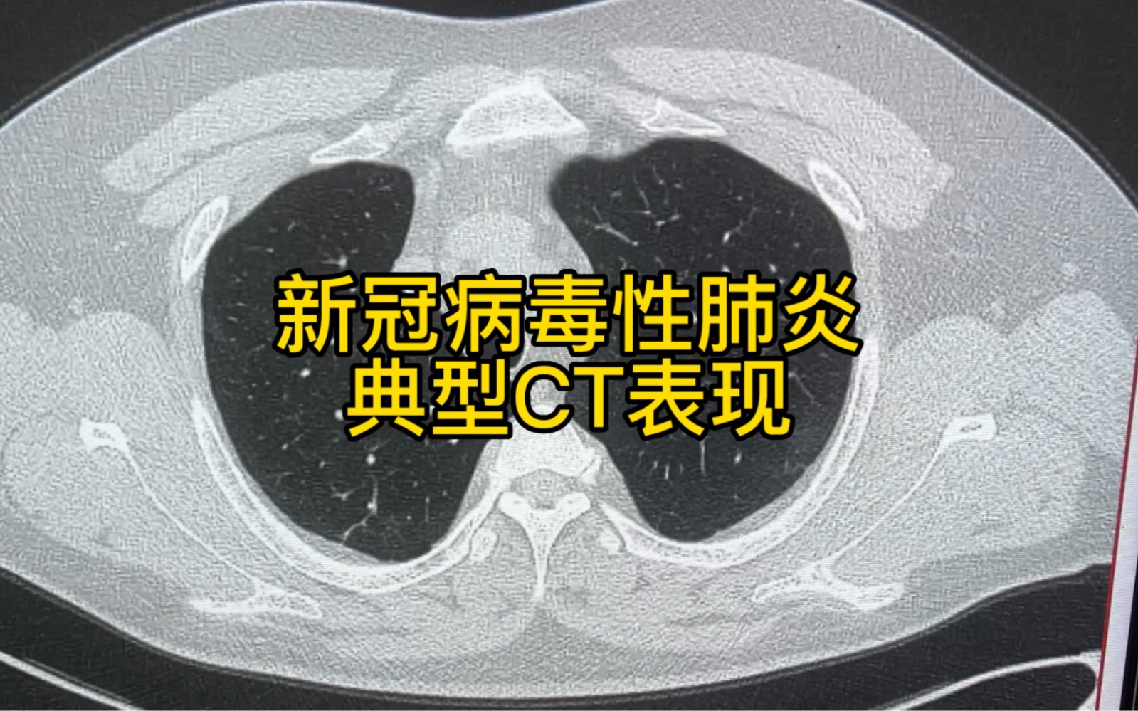新冠病毒性肺炎典型CT表现,两肺多发磨玻璃密度影,以近胸膜下为著