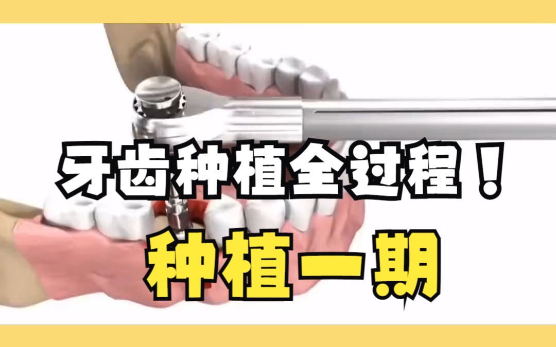 种牙的步骤流程 种植牙全过程演示