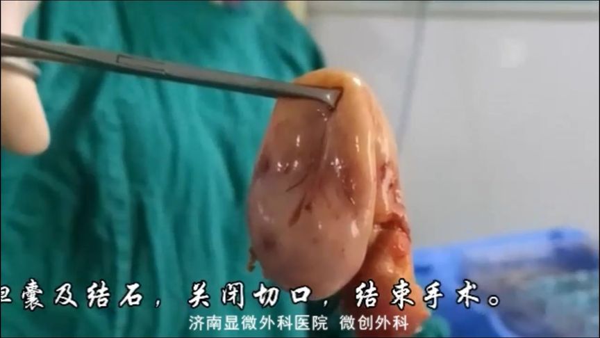 微创双镜联合胆囊切除加胆总管取石术