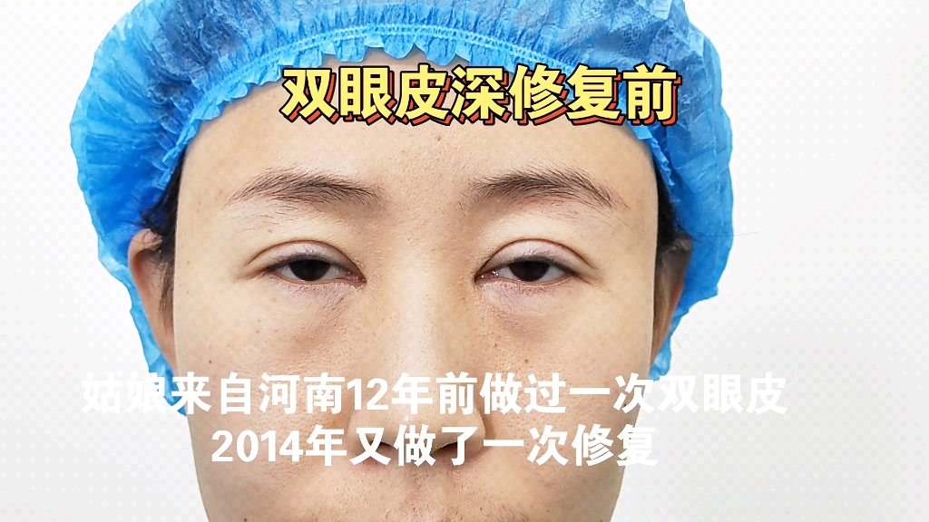 ...做了2次还是不好,双眼皮深瘢痕明显,来做修复,修复后效果改善明显。