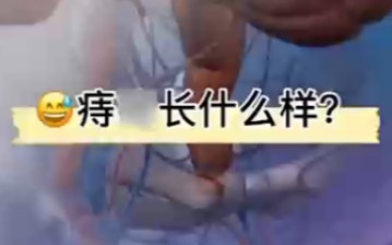 得过痔疮的人都知道很痛苦,却不知道这个折磨人的玩意儿长什么样,...