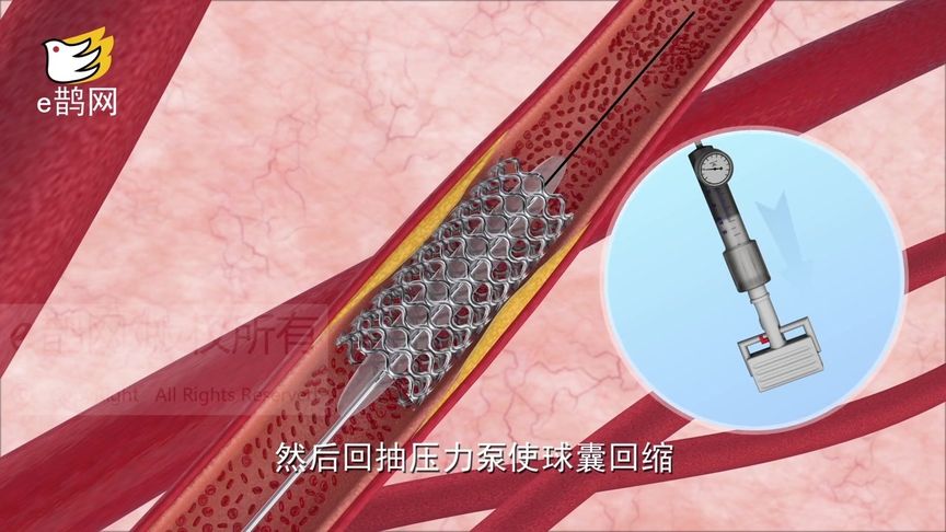心血管堵塞的克星:心脏介入手术