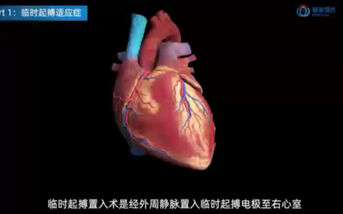 漂浮临时起搏电极导管置入方法