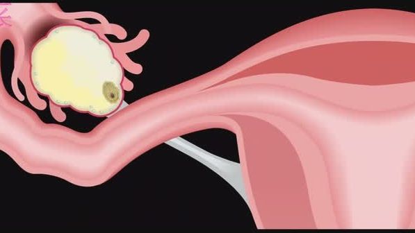 3D动画演示排卵以及受孕全过程,原来我们都是从这样开始的