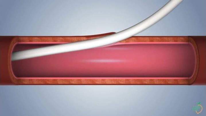 动画演示-股动脉穿刺置管