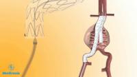 10、腹主动脉覆膜支架手术