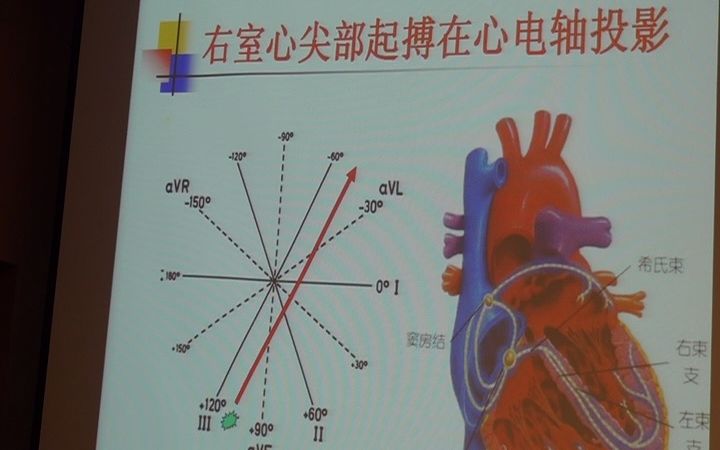 临时心脏起搏技术