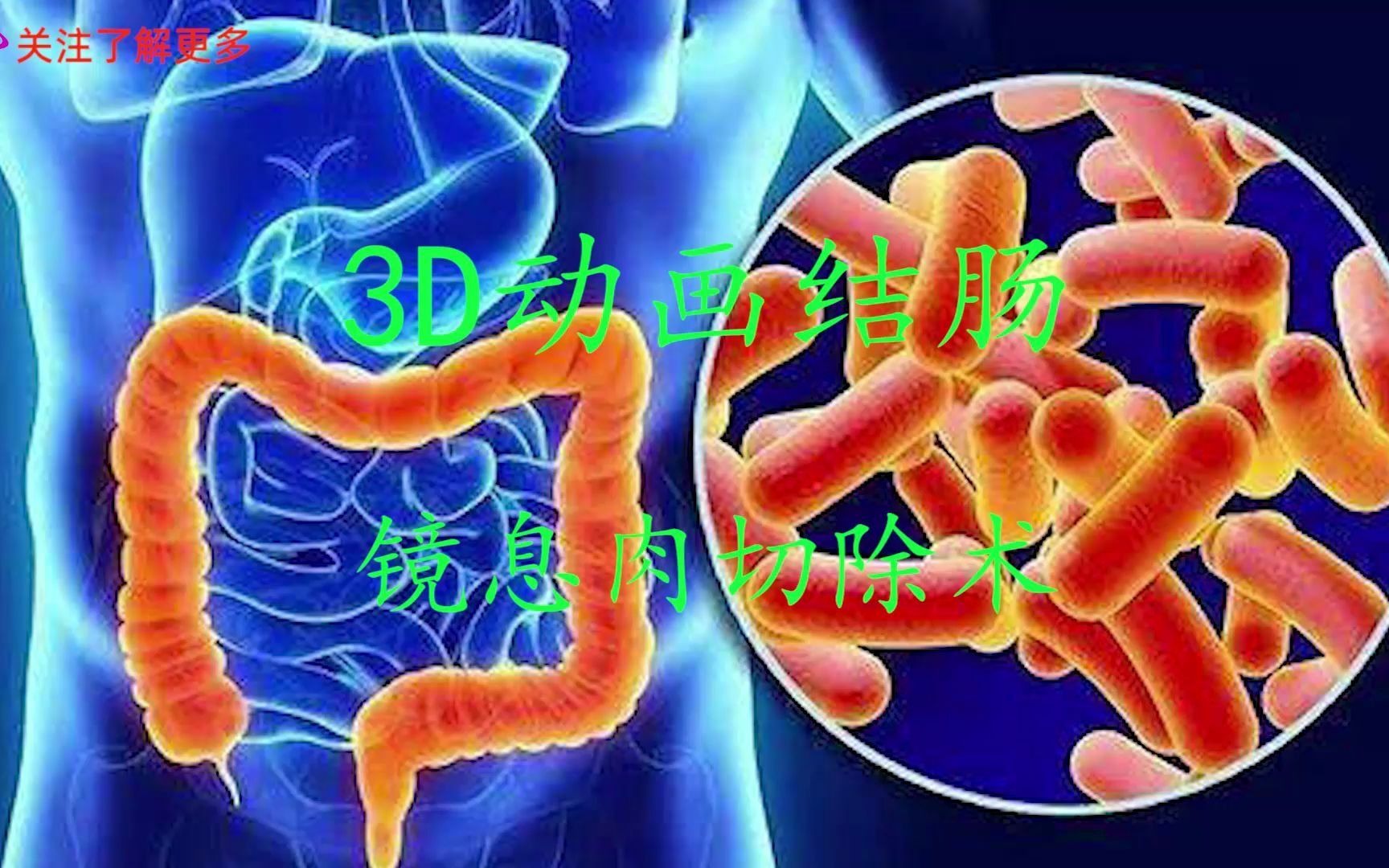 3D动画结肠镜息肉切除术