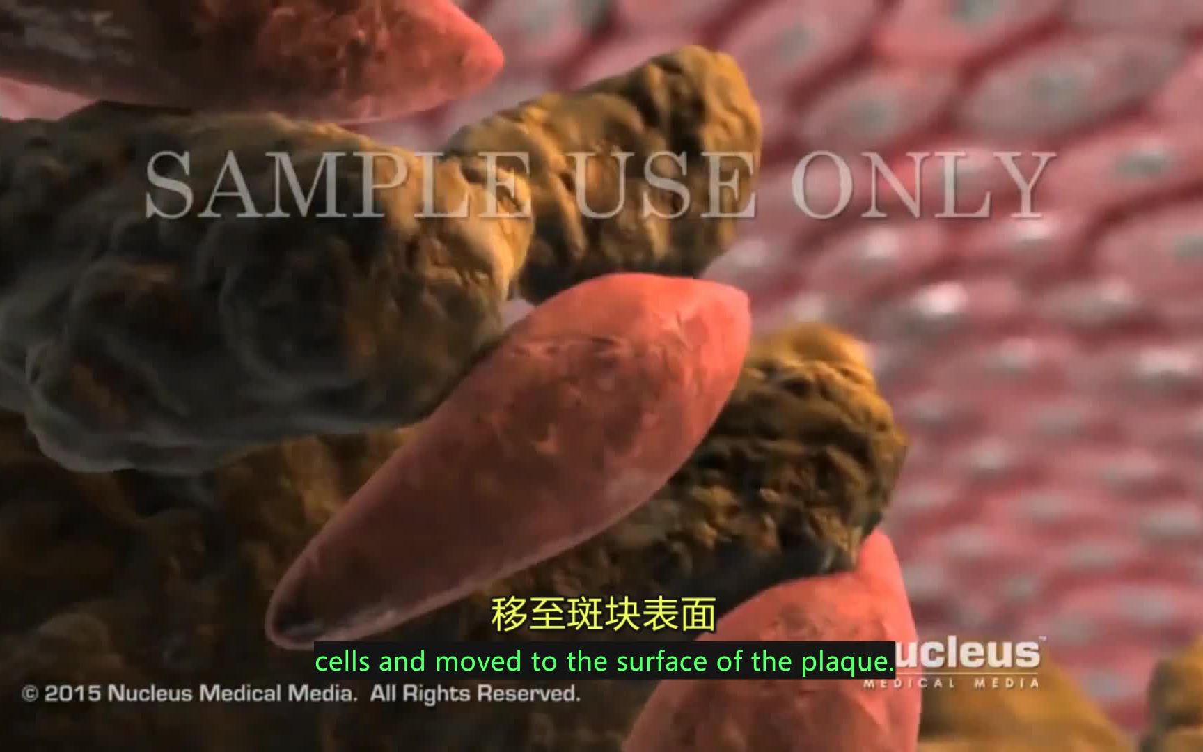 【3D医学动画】心梗系列第一期▁▁动脉硬化(原版+中英双字幕)