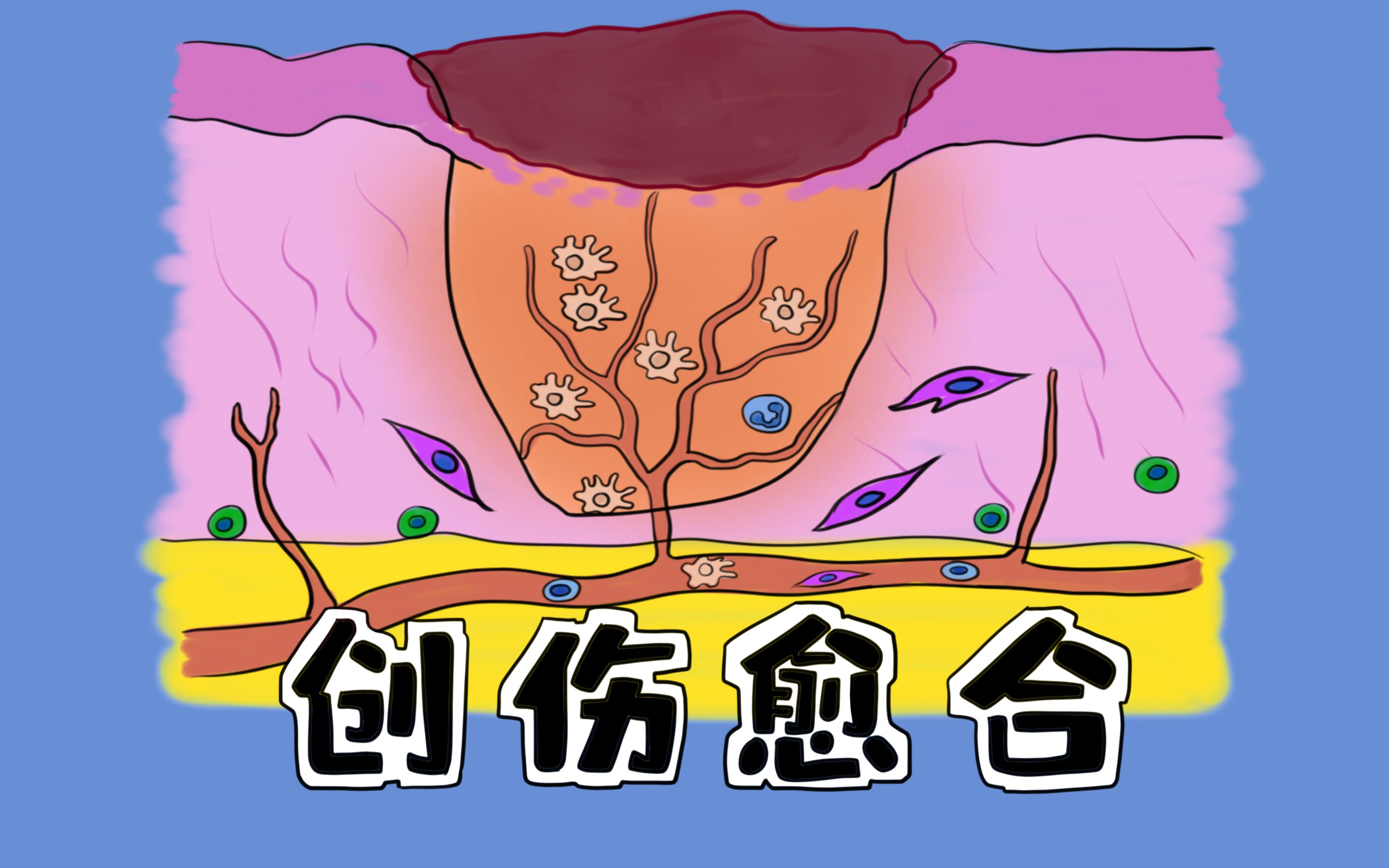 手绘精讲 | 创伤愈合过程 + 肉芽组织