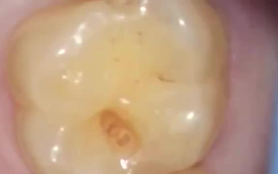 蛀牙修复:牙齿轻微龋坏的修复过程!