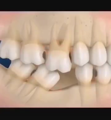 牙齿缺失后的演变