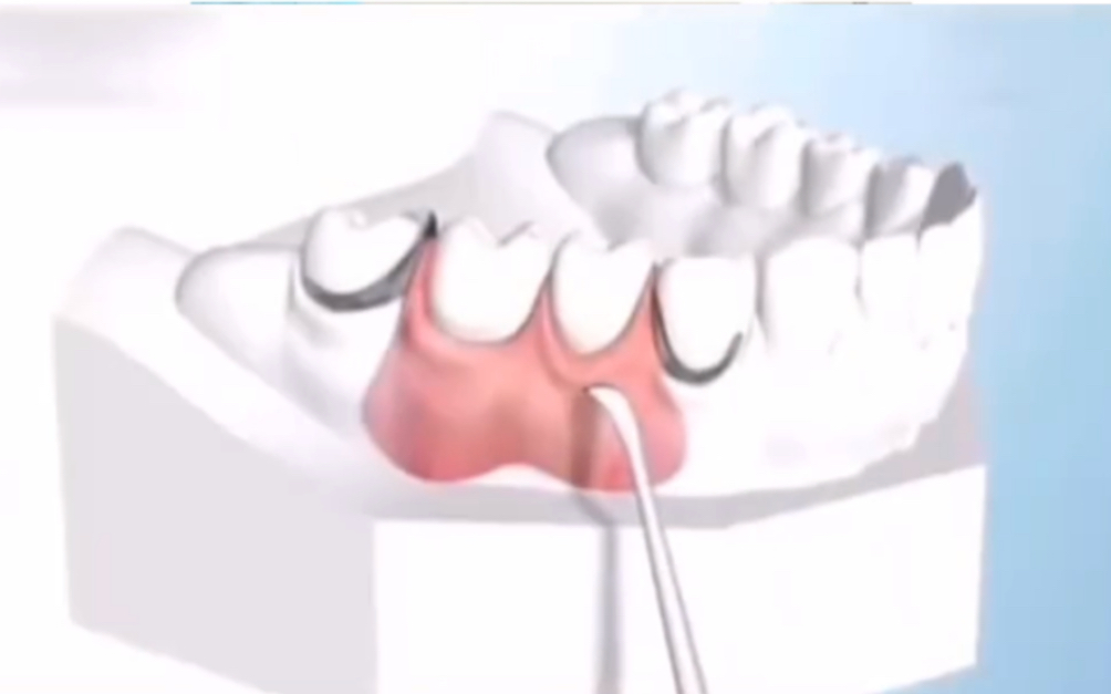 牙齿掉了不想种牙怎么办?