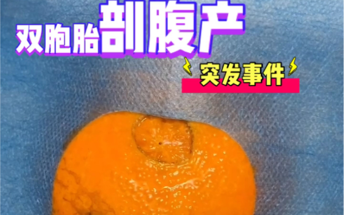 为什么新生儿会神经管畸形?因为叶酸