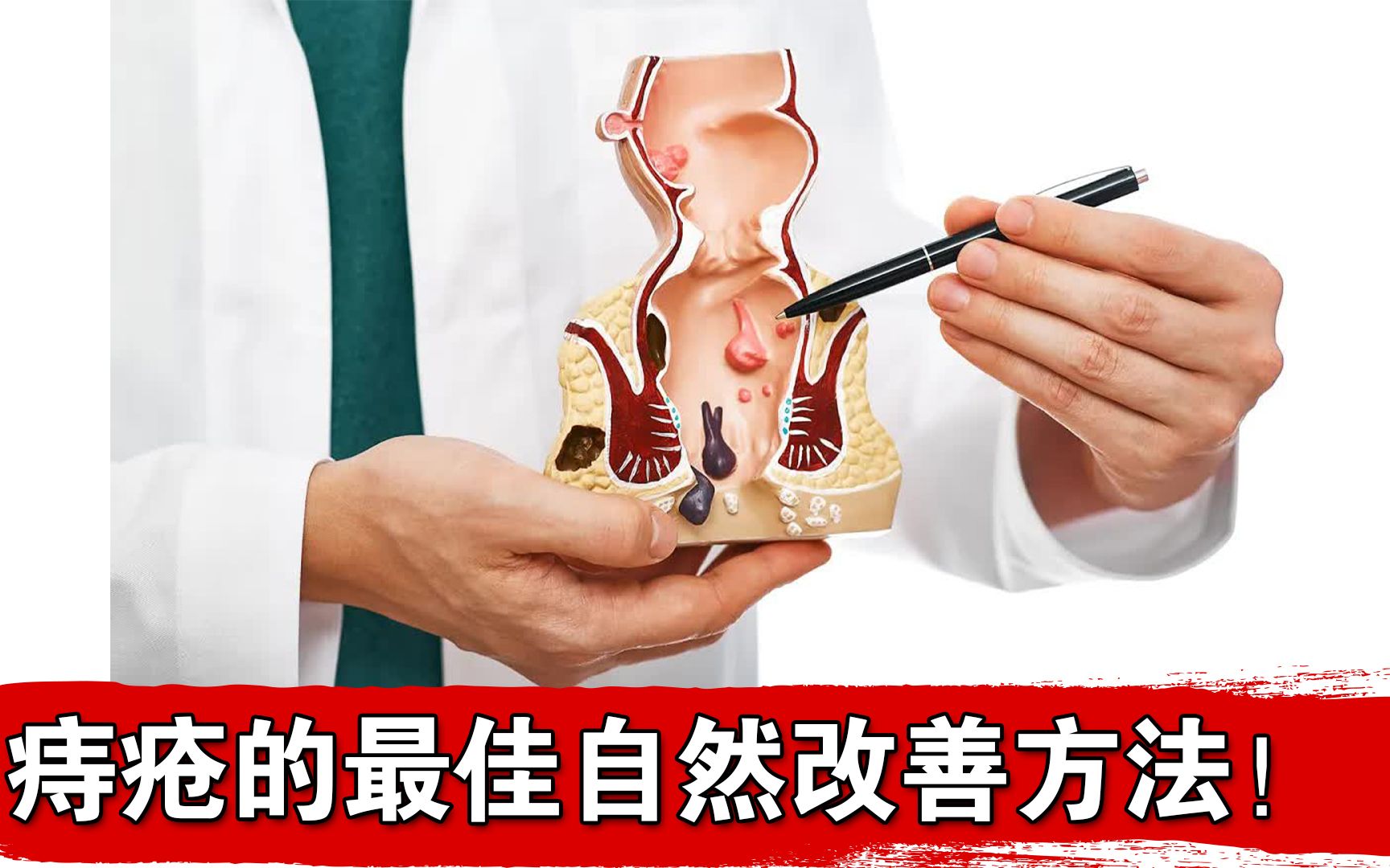 痔疮的最佳天然改善方法!