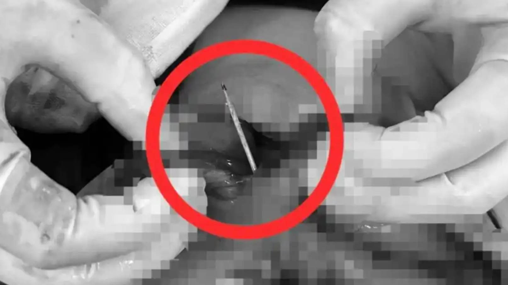 75岁老人腹痛当阑尾炎治疗后晕倒,手术发现肠道被刺破两个洞,系其...