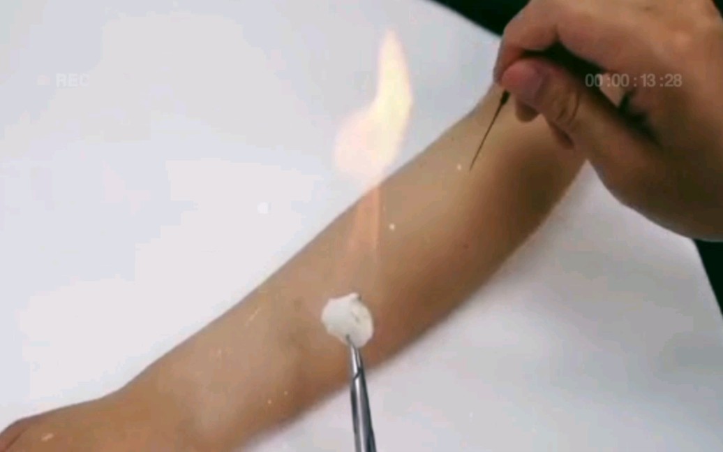 “天津火针团队”带您了解认识神奇的古老针刺术——火针疗法