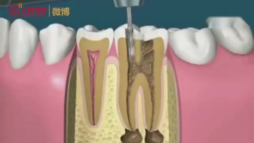 一分钟看懂“根管治疗”!
