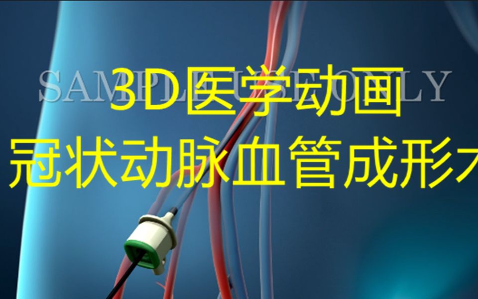 冠状动脉血管成形术也称为经皮冠状动脉介入术。该程序是在称为冠状...