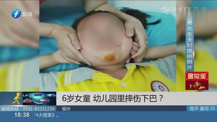 6岁小孩在幼儿园受伤,下巴竟有一个洞,领口全是血迹!
