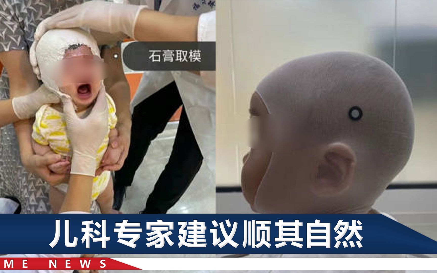 “孩子不能是扁头!”家长给婴儿戴石膏矫正模型,这么容貌焦虑吗