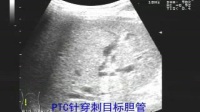 超声引导下经皮经肝胆管穿刺置管1