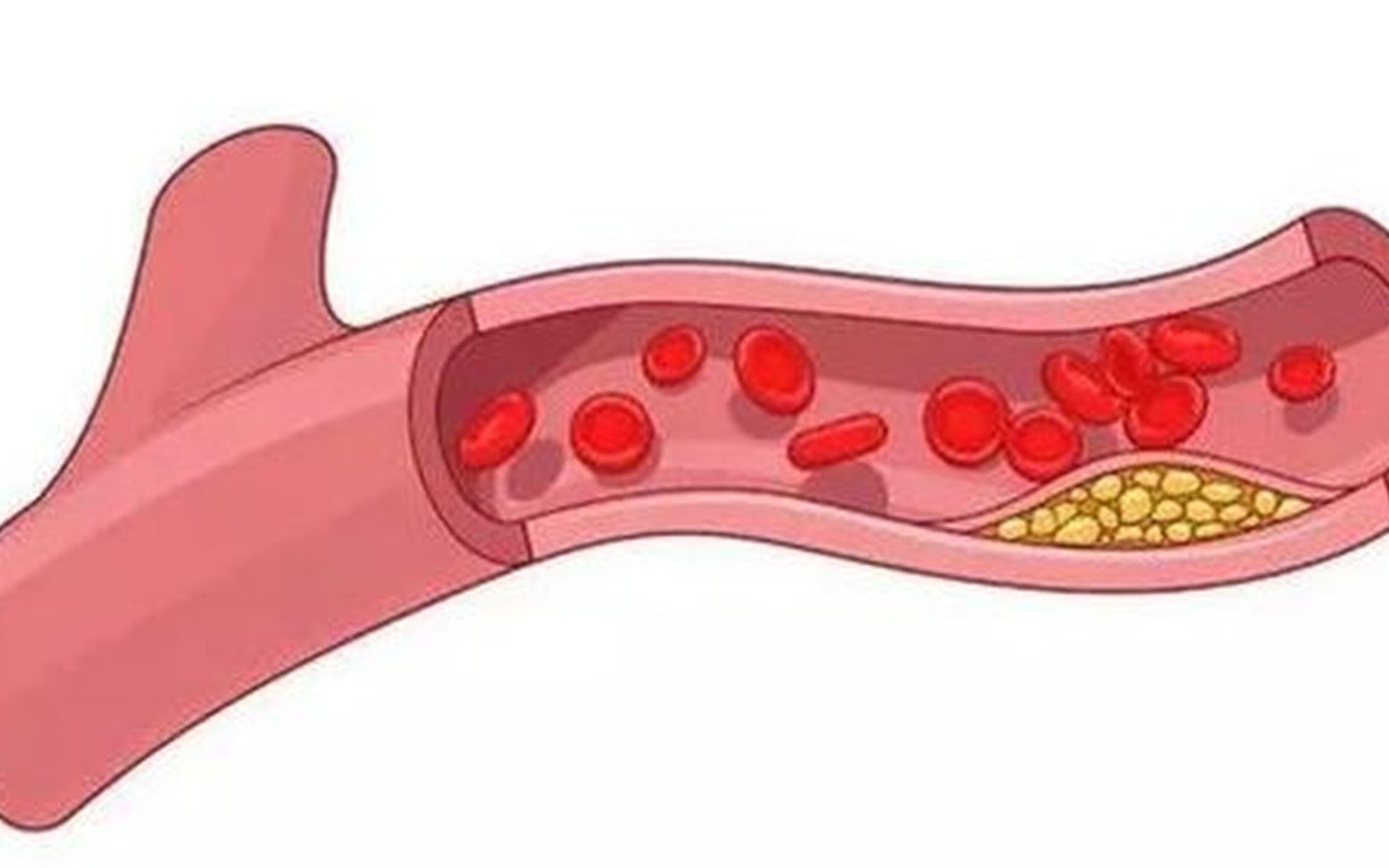 动脉出现粥样斑块很危险!应该怎样应对?中医养心汤为您解忧愁