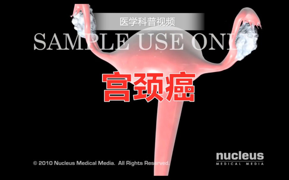【医学科普视频】:宫颈癌