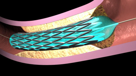 心脏支架是怎么如何安心脏里的?3D动画演示全过程,看完很舒服