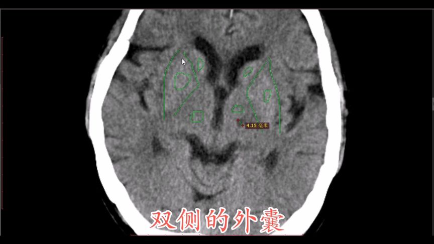 脑卒中之基底节腔隙性脑梗塞,老年人常见,基底节解剖-全是干货