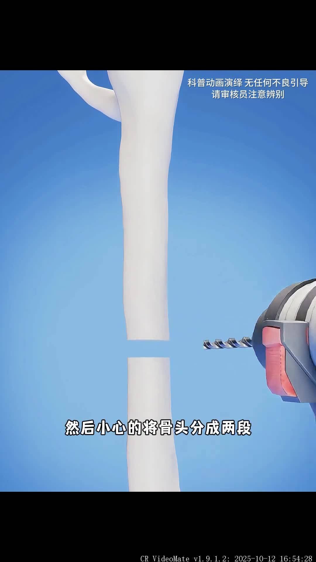 神奇的断骨增高术,是如何进行的