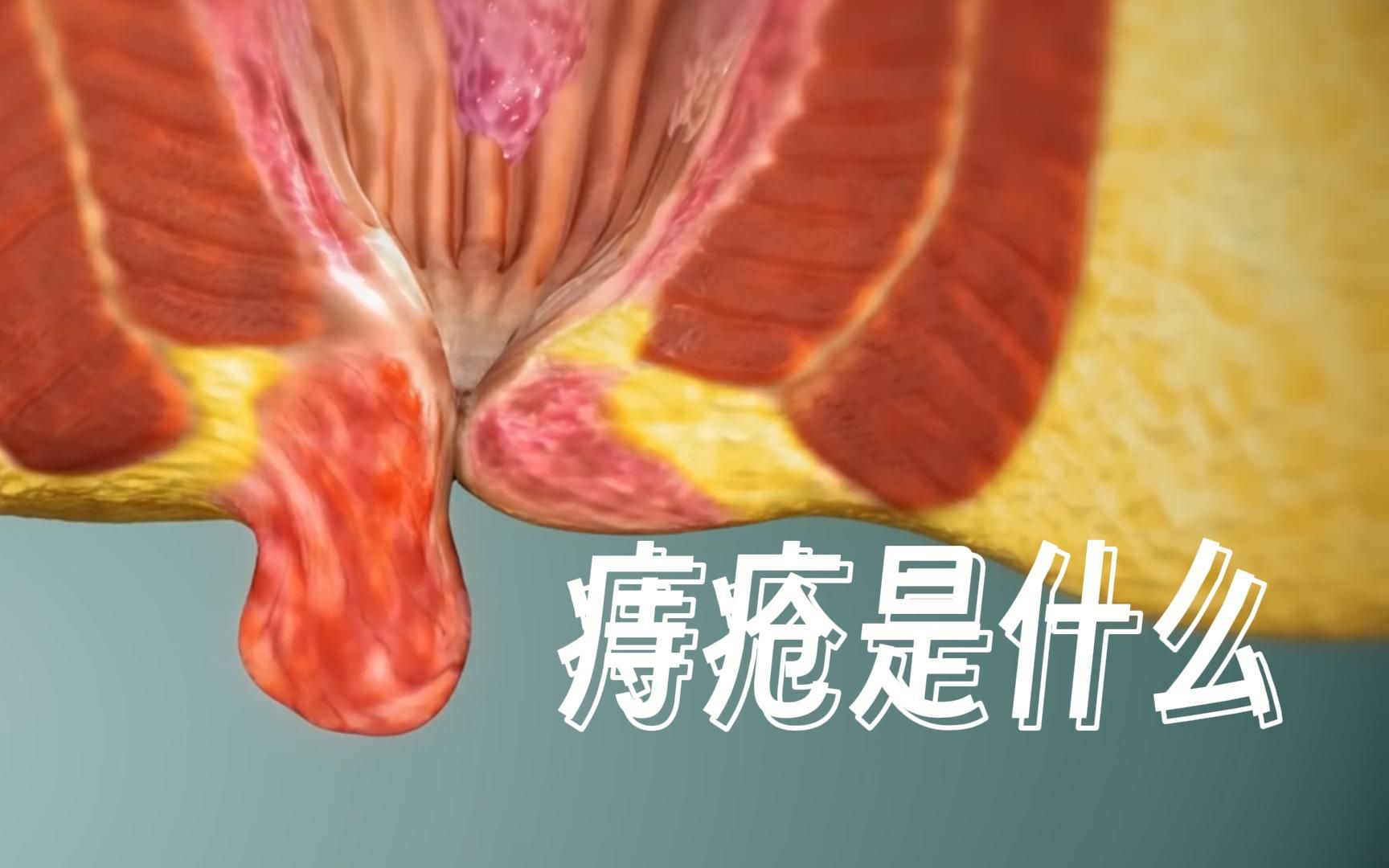 奇妙的内部:痔疮的产生