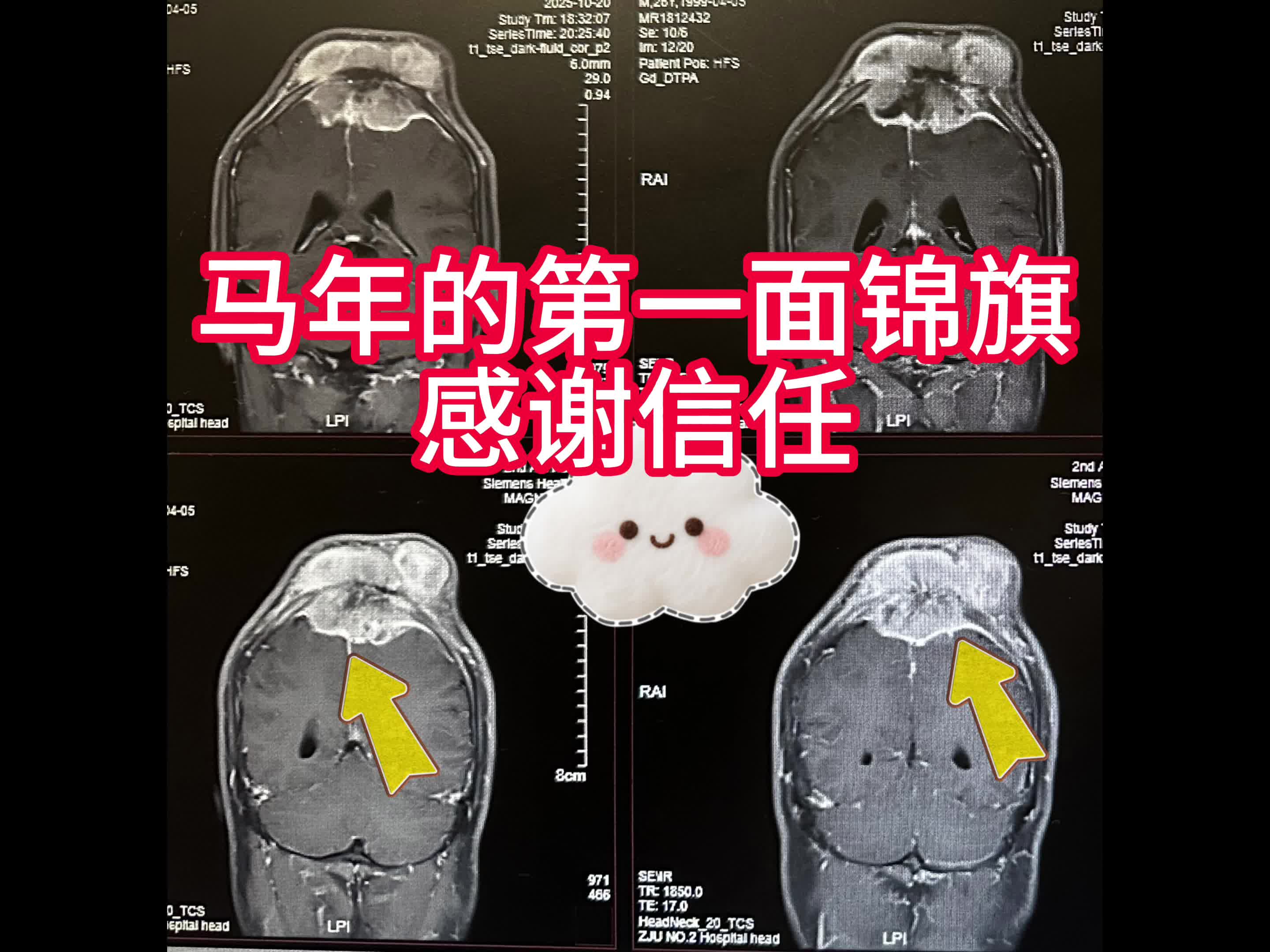 马年的第一面锦旗 马年的第一面锦旗来自10月份开的巨大脑膜瘤湖北...