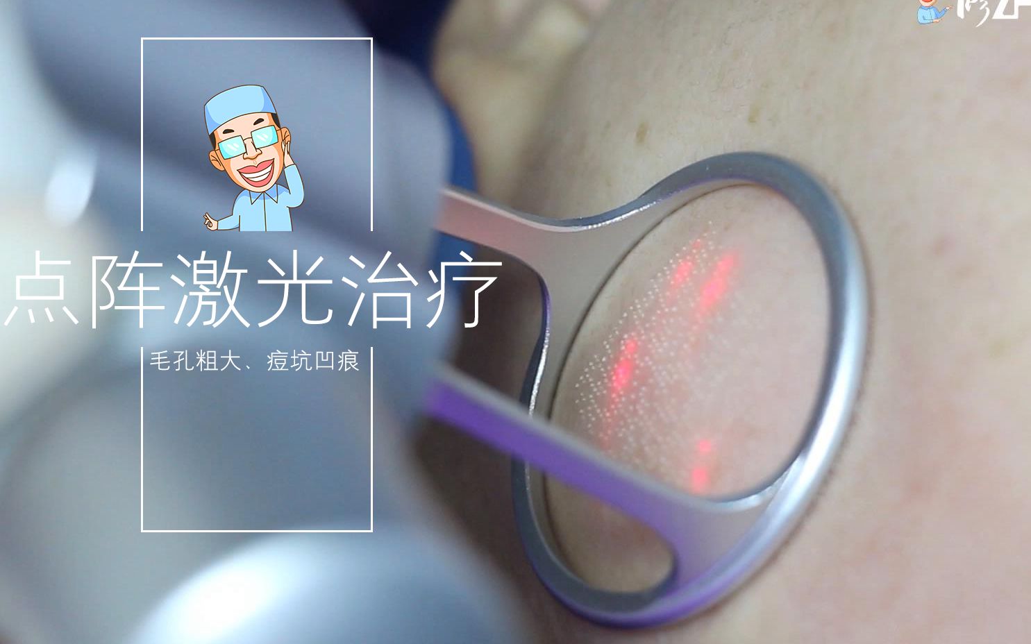 毛孔、痘坑的克星——点阵激光,近距离感受一下!