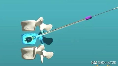 3D解读椎体成型术
