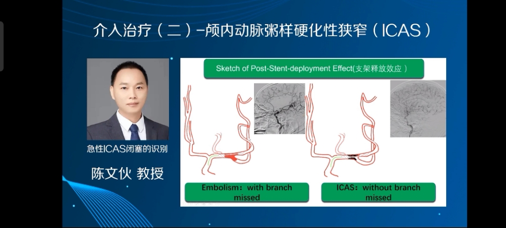 急性大血管闭塞性脑梗死,神经介入微创取栓,微导管首过效应