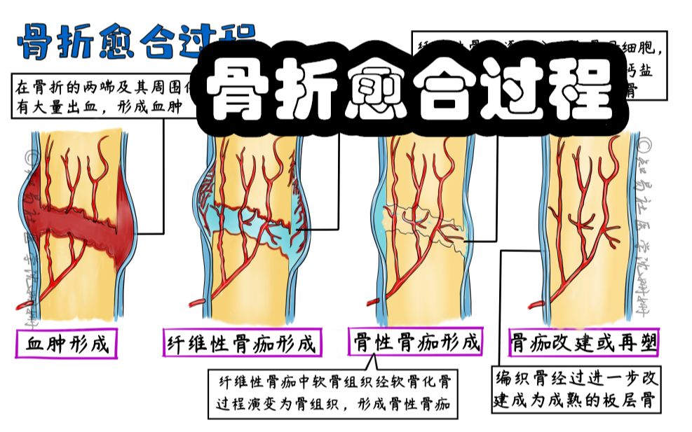 医学生动画演绎 病理学考点 骨折的愈合过程