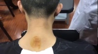 针灸刺落放血视频,大椎放血治疗高血压,颈椎病