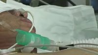 经气管插管气管切开吸痰法