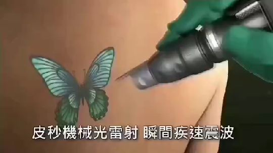 皮秒激光祛斑原理