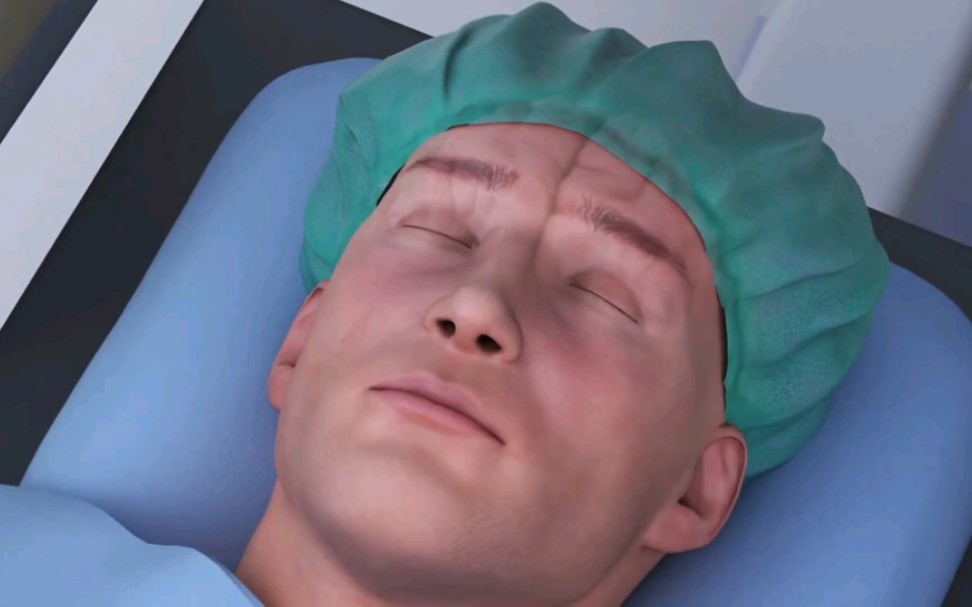 这才是医术精湛,介入微创支架加弹簧圈治疗脑动脉瘤,3D演示。