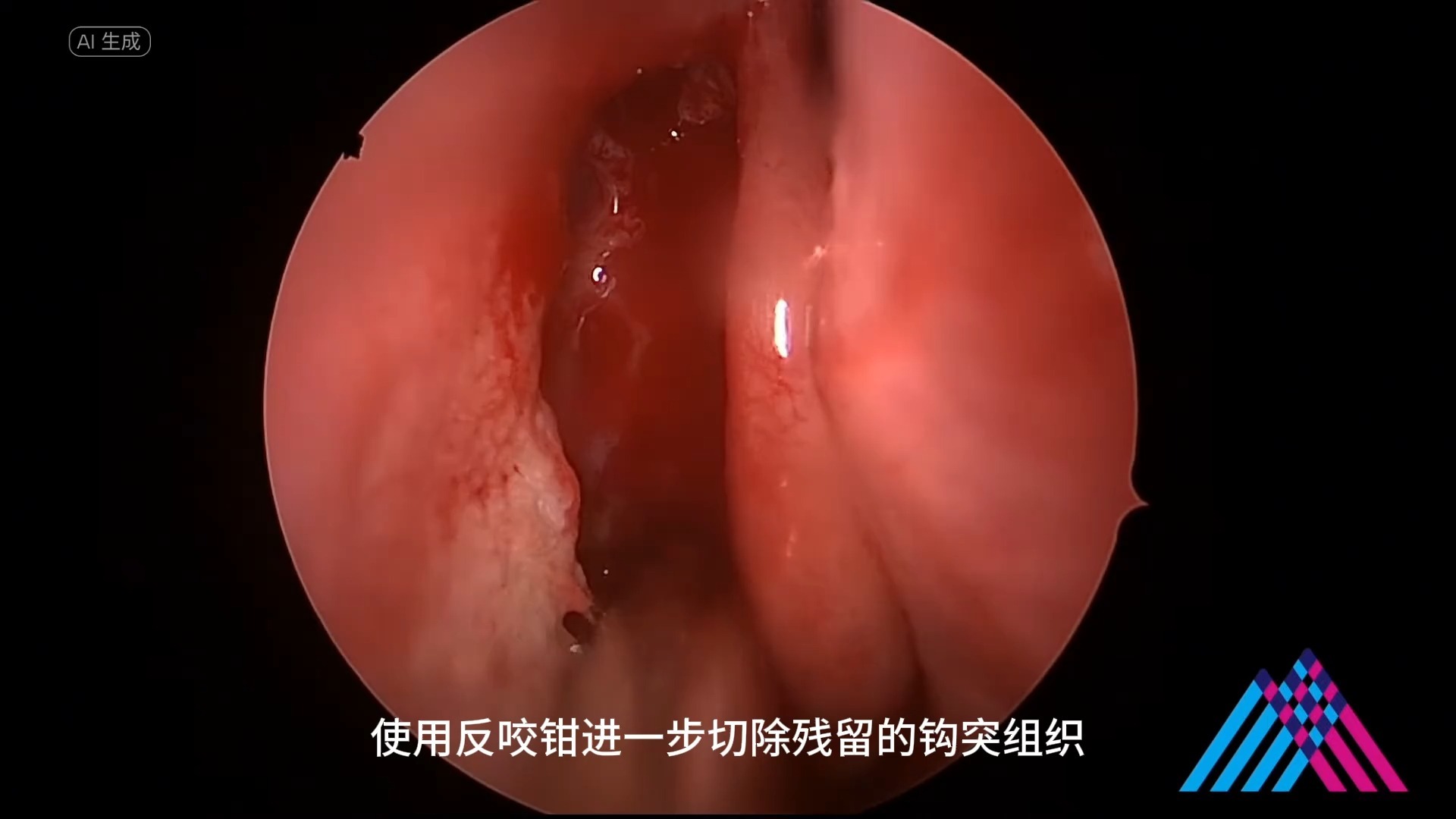 功能性内镜鼻窦手术治疗(非医学相关专业慎入)