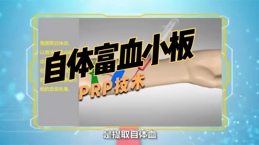 自体富血小板血浆PRP技术