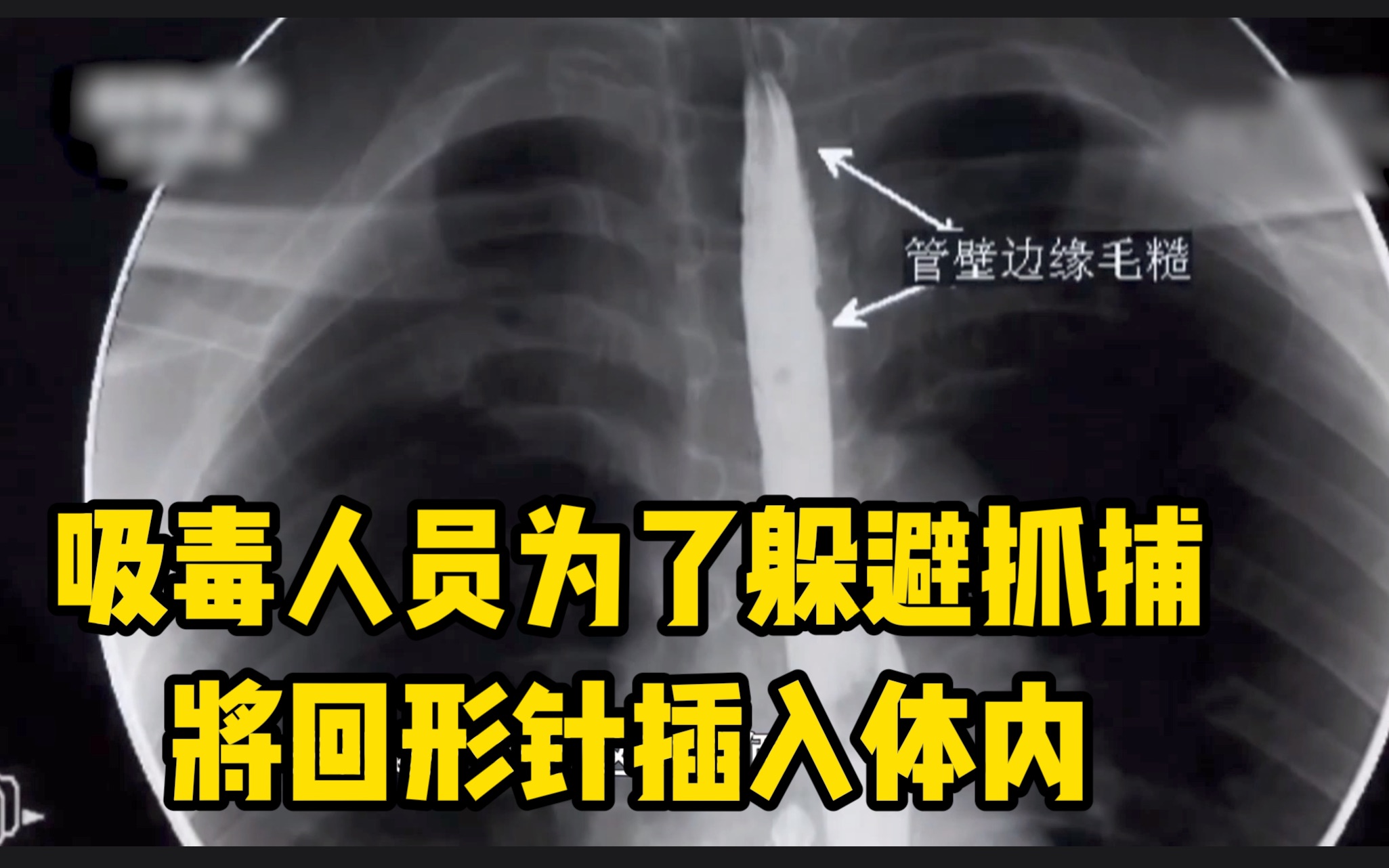 吸毒人员为了躲避抓捕,将回形针插入体内