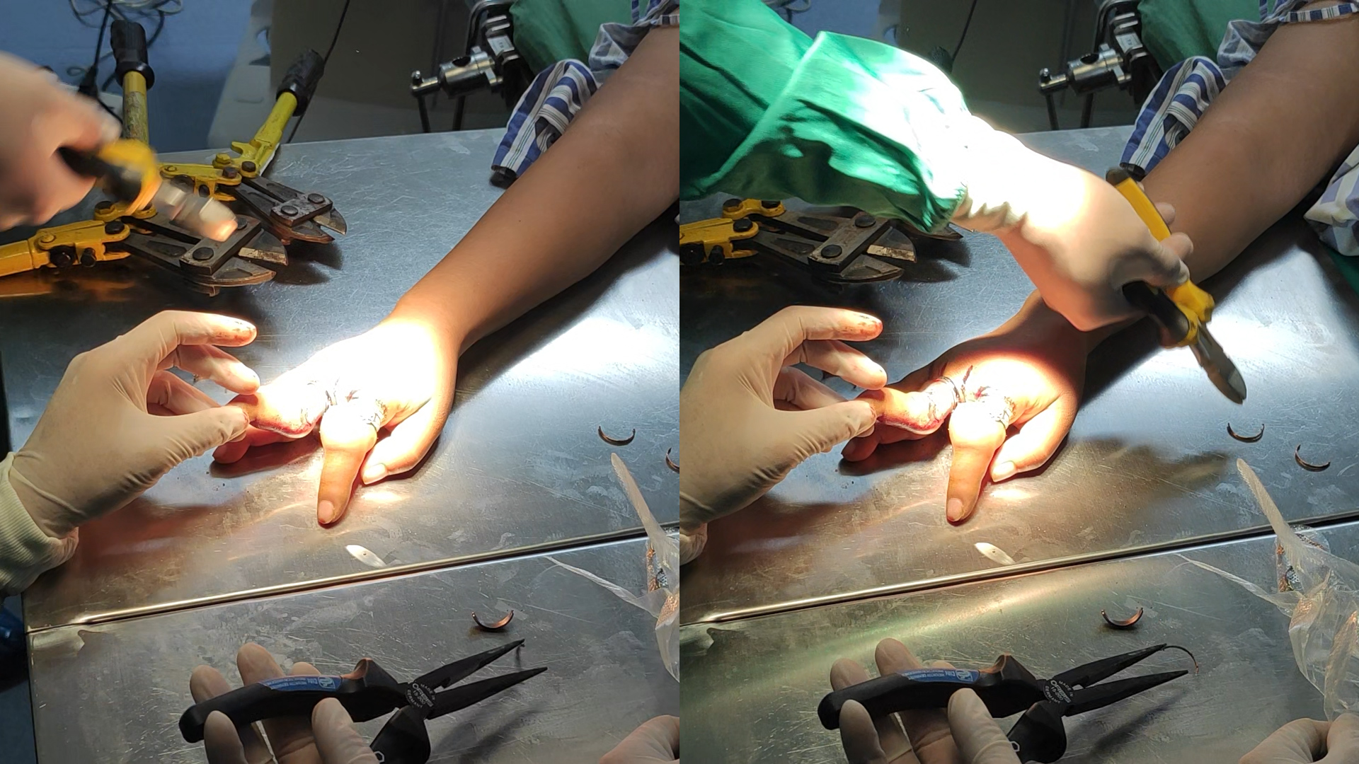 女子戴9枚戒指致右手肿胀流脓,消防医护合力救援,网友:隔屏痛