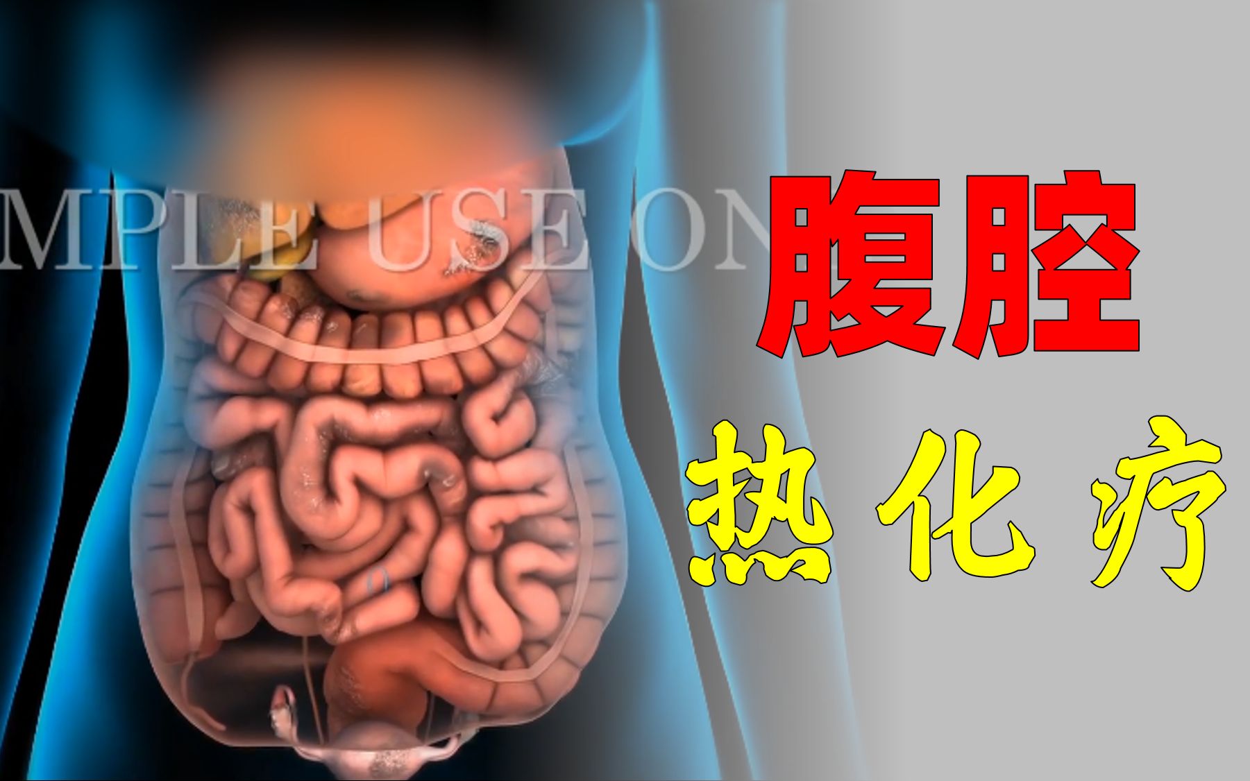 【3D医学动画】腹腔热灌注(中英双字幕)