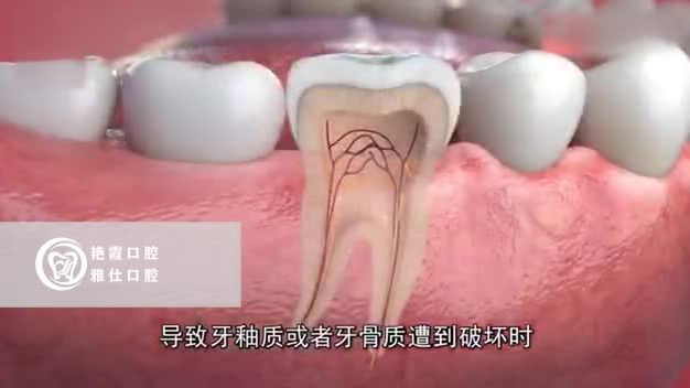 带你了解牙齿中的根管治疗