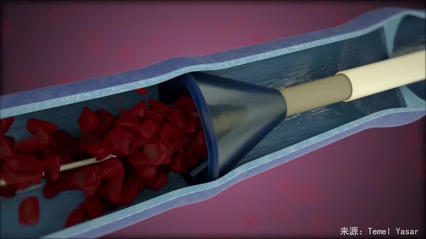 3D动画:血栓切除术