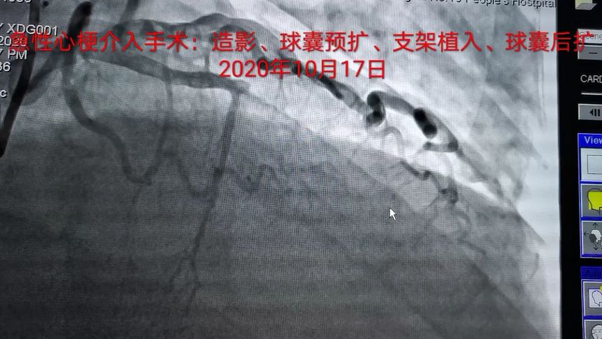 “心梗”急诊手术全过程:为什么血管打通还需要放支架?